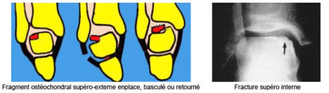 Lésions ostéochondrales du dôme astragalien (LODA) - Pôle locomoteur de ...